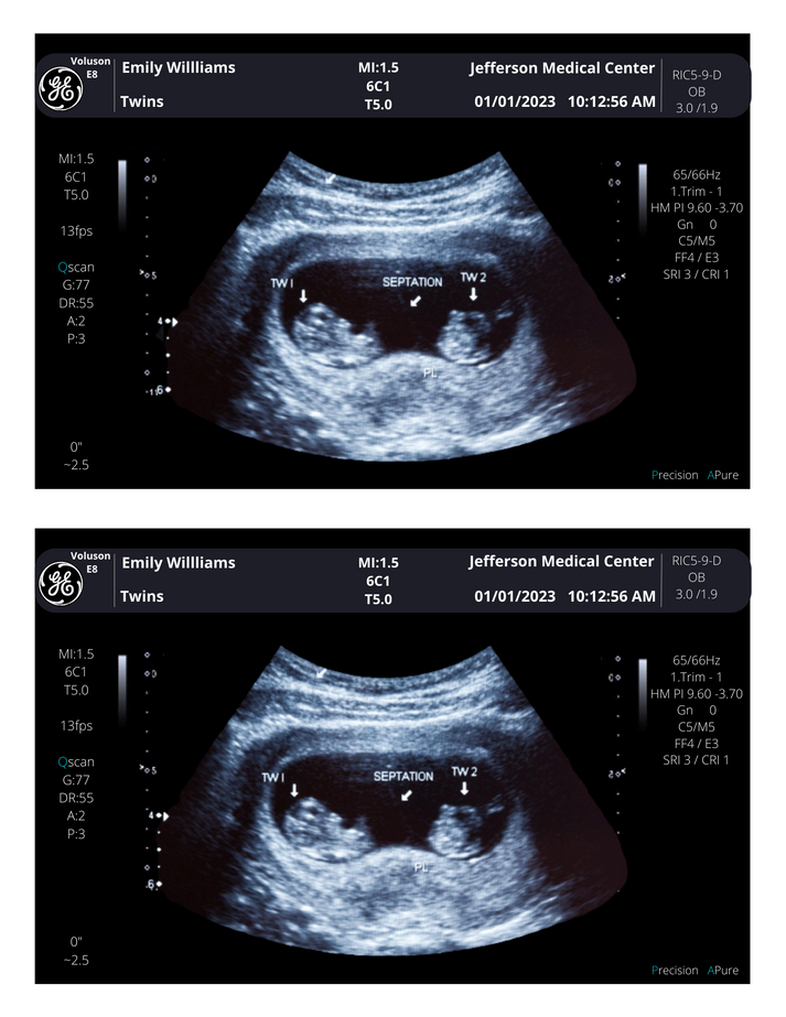 Customizable Ultrasound Picture. From 3-40 weeks. Personalized Sonogram Picture and Pregnancy ...