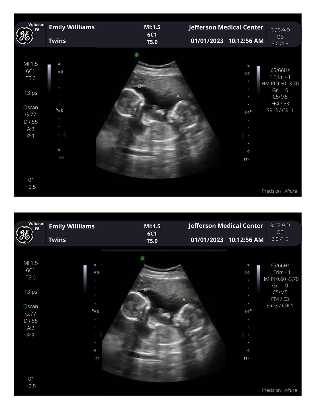 4 Weeks Pregnant Ultrasound: Your First Glimpse into Pregnancy – creetify