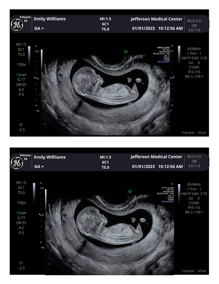 Customizable Ultrasound Picture. From 3-40 weeks. Personalized Sonogram ...