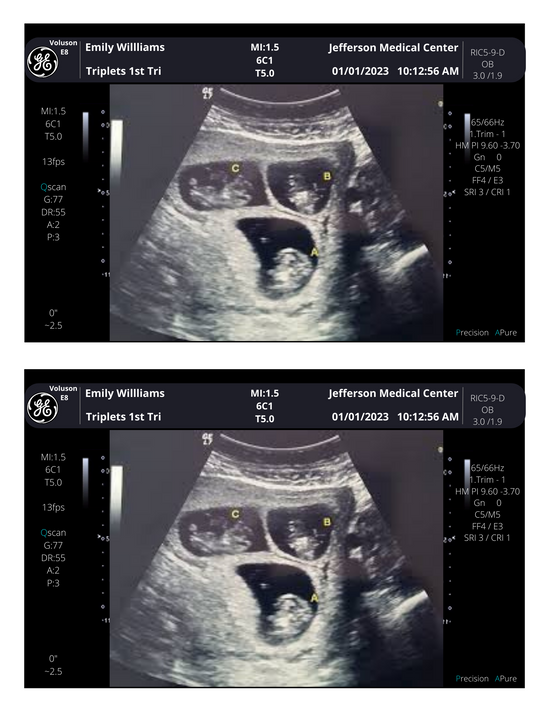 Twins Fake Sonogram Picture!! From 3-40 weeks! | Customizable Digital ...